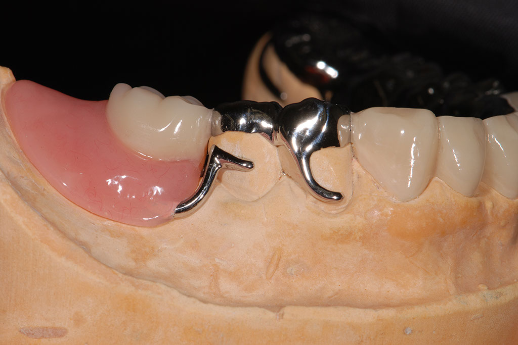 Overlay Denture